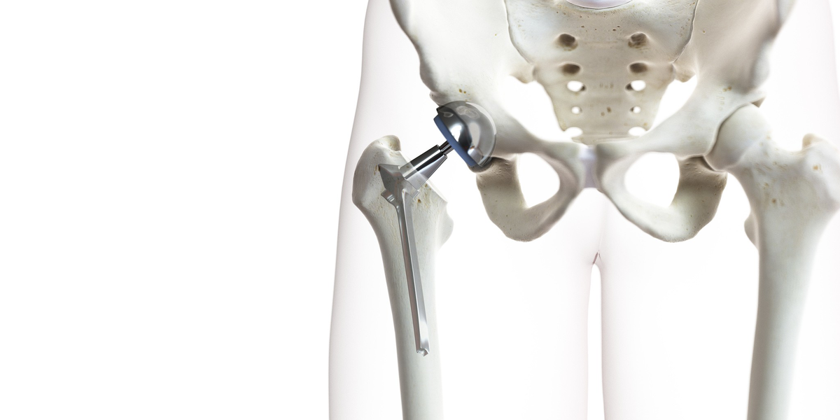 Hip Replacement Components | Seco Tools